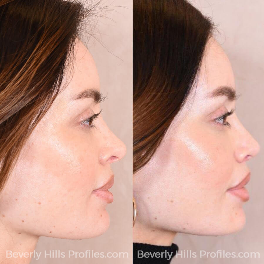 Top Revision Rhinoplasty Beverly Hills | Best Nose Job in LA