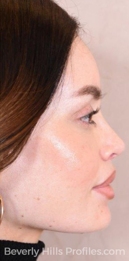 Top Revision Rhinoplasty Beverly Hills | Best Nose Job in LA