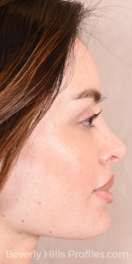 Top Revision Rhinoplasty Beverly Hills | Best Nose Job in LA